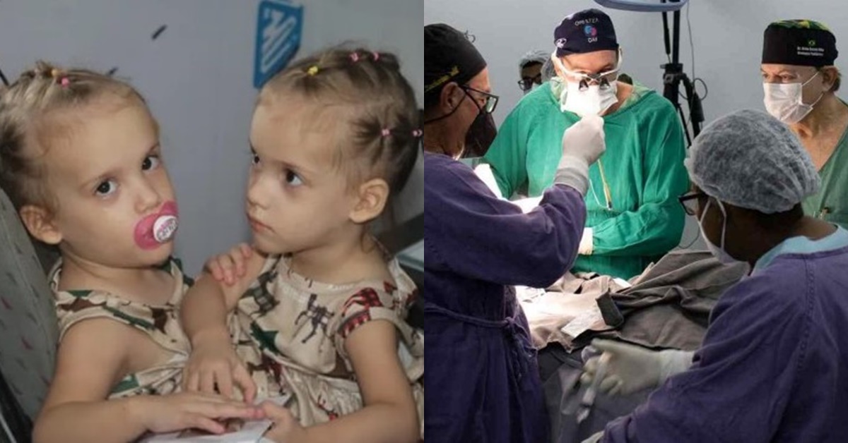 Gêmeas siamesas são separadas em cirurgia de 16 horas de duração